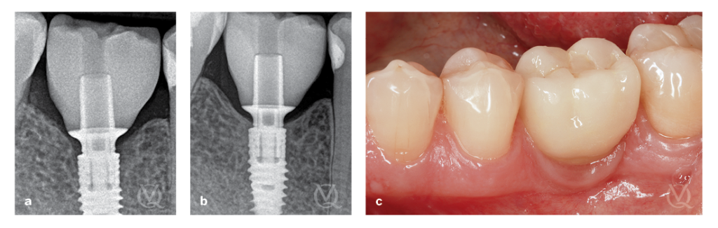 Challenging Scientific Paradigms: Zero Bone Loss Concepts ...